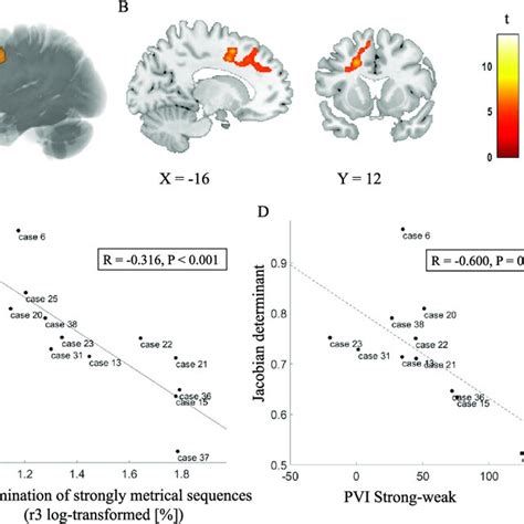 deformation based morphometry dbm analysis comparison of controls