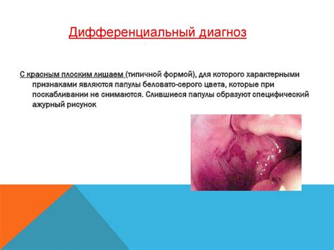 Кандидоз полости рта у детей презентация онлайн