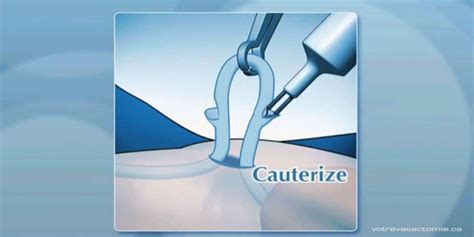 Video Of How A No Scalpel Vasectomy For Male Birth Control Works