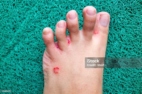 Tinea Pedis Fungal Infection Or Athletes Foot A Red Scaly Rash