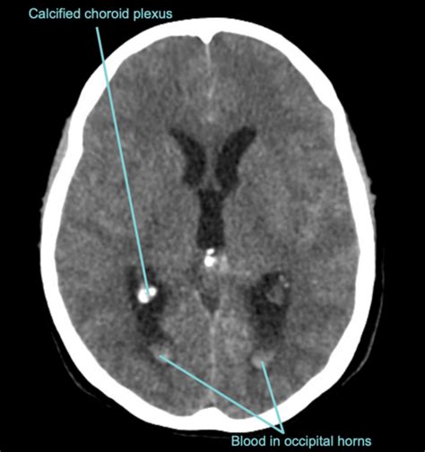 Ct Case 016 • Litfl • Ct Scan Interpretation