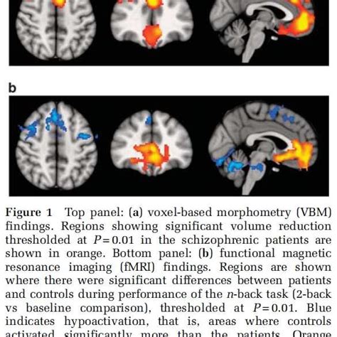 Pdf Medial Prefrontal Cortex Pathology In Schizophrenia Convergent