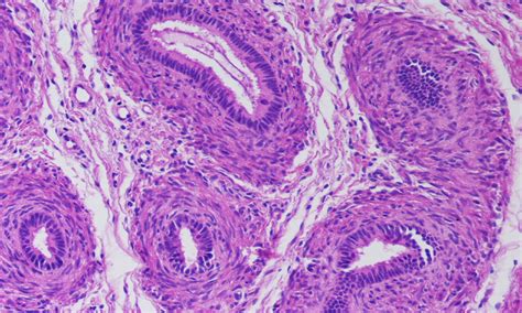 Micropene Y Criptorquidia Bilateral Secundarios A Síndrome De Regresión