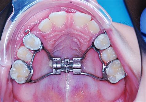 Disjunctor Orto Dental