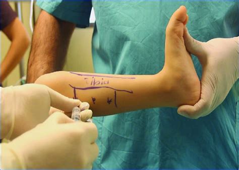 Application Technique Of Botulinum Toxin A Bont A Injection To The Download Scientific