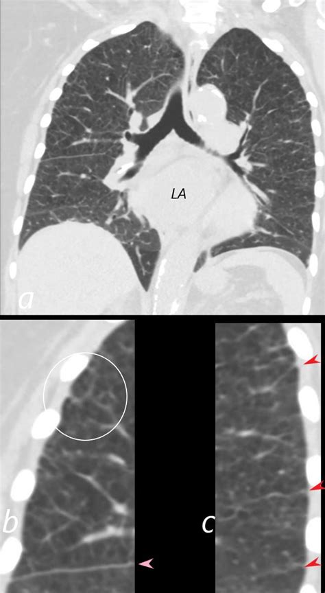 Faces Of Emphysema The Common Vein