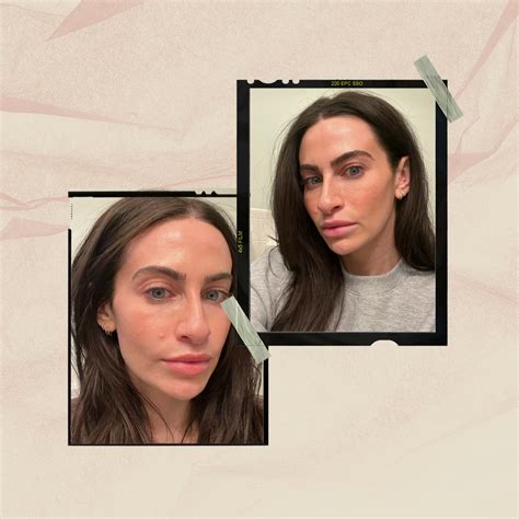 Daxxify Is The Longer Lasting Botox Alternative You Need To Know