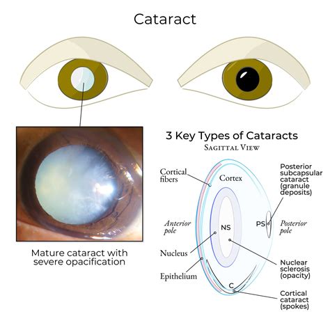 Nuclear Sclerosis Cataract