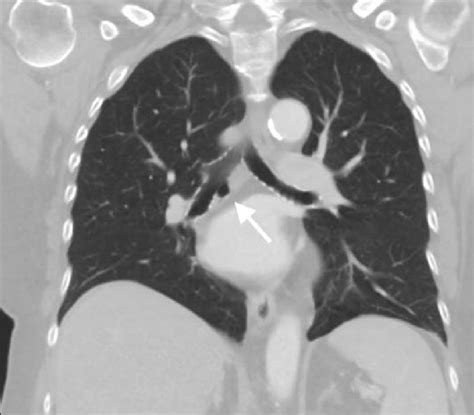 CT Scan Coronal View Arrow Showing Accessory Cardiac Bronchus As A