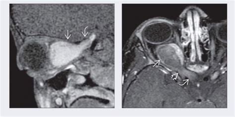 Optic Glioma Radiology