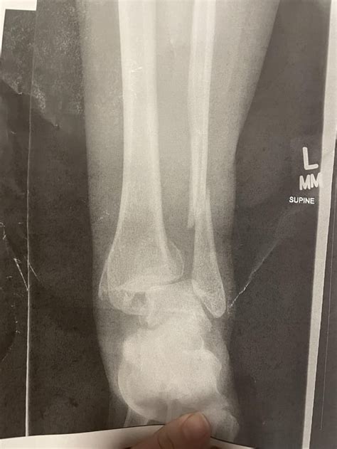 Anyone Have Success With A Jas Splint For Flexion And Extension After