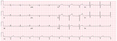 Why Is The Angiogram Normal Dr Smiths Ecg Blog