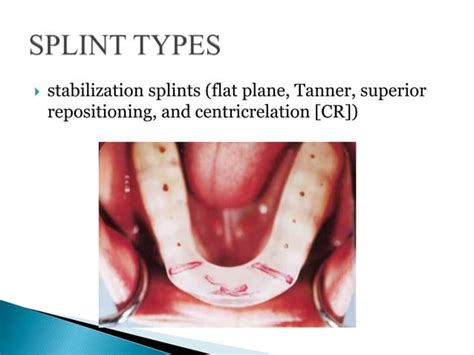 Splint Therapy For Tmj Disc Displacement Pptx Physical Therapy
