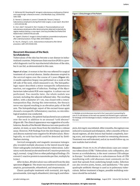 Recurrent Abscesses Of The Neck Scrofuloderma Tuberculosis Of The Skin Has Become A Rare