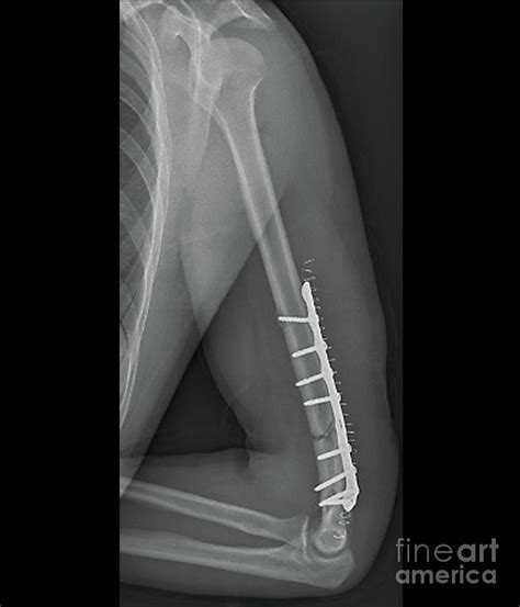 Fixed Upper Arm Fracture 3 Photograph By Science Photo Library Pixels