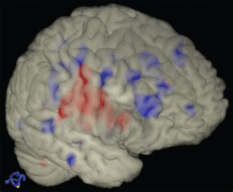 Jle Epileptic Disorders Ictal Spect Reveals Different Epileptogenic Zones In Frontal Lobe