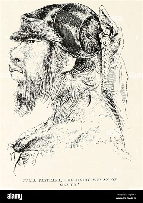Hypertrichosis Girl
