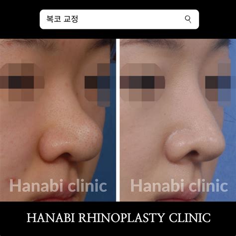 Before And After Image Of Rhinoplasty For Bulbous Rounded Tip Hanabi Rhinoplasty Clinic