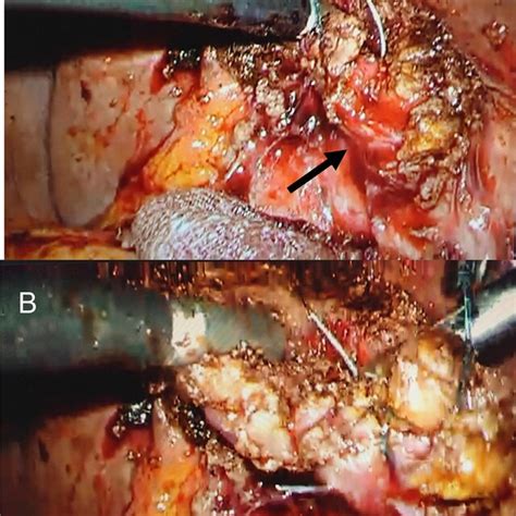 A Laparoscopic Image Shows The Stump Of The Gallbladder Infundibulum Download Scientific