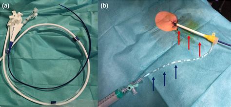 Percutaneous Transhepatic Cholangioscopy Using A New Single‐operator