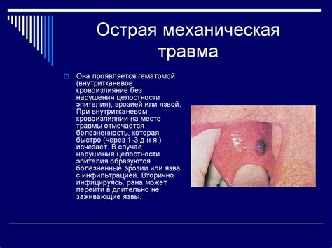 Травматические поражения слизистой полости рта Online Presentation