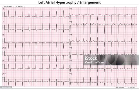 Ekg Hipertrofi Atrium Kiri 12 Kasus Umum Ekg Timbal 6 Detik Timah Ilustrasi Stok Unduh Gambar