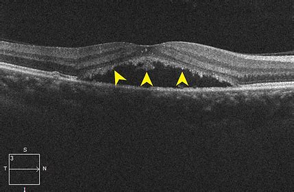 OCTcases Retina Case 26