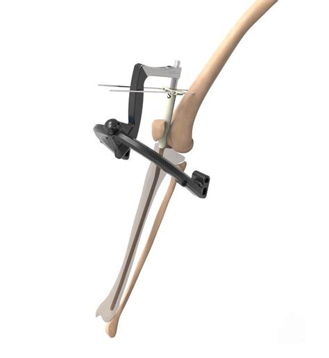 Pnp Tibia Orthopediatrics