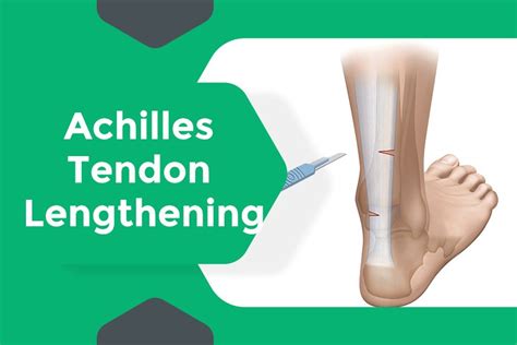 Hospital For Achilles Tendon Lengthening Surgery In Surat