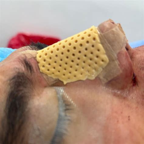 Thermoplastic External Nasal Splint For Nose Surgery Fracture