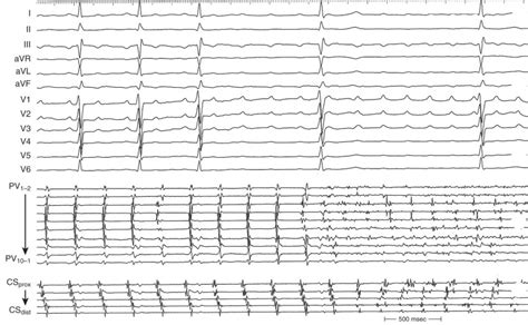 Macroreentrant Atrial Tachycardia Thoracic Key