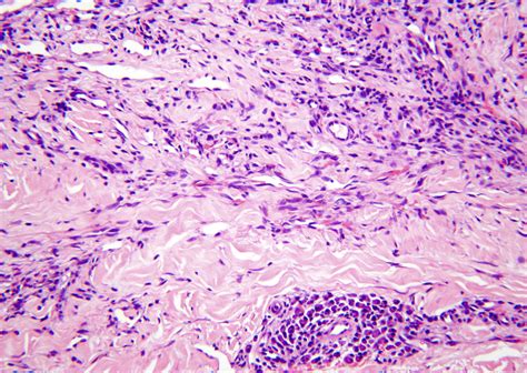 Kaposi Sarcoma Histology