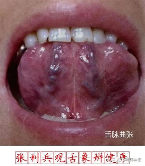 张利兵：“观舌象辨健康”第28讲 舌下脉络诊病 知乎