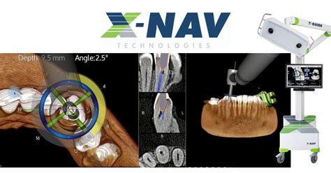X Guide Dynamic Navigation Receives Fda 510k Clearance To Aid In