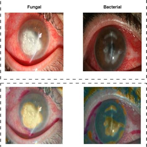 Slit Photo Samples Of Healthy Eye And Different Types Of Keratitis