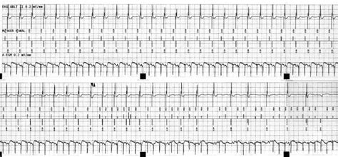 Simultaneous Recordings Of Surface Ecg Lead Ii Paper Speed 25 Mms Download Scientific