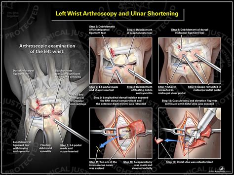 Left Wrist Arthroscopy And Ulnar Shortening Custom Medical