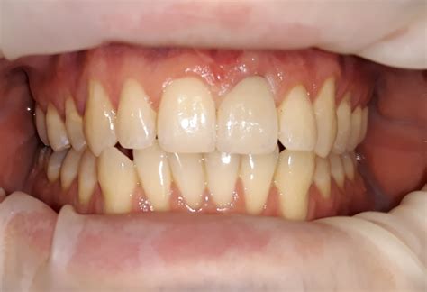 E Max Ceramic Is Perfectly Identical To Natural Teeth As You Can See