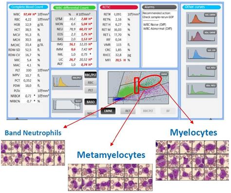Clinical Case 1 Acute Myeloid Leukemia Horiba