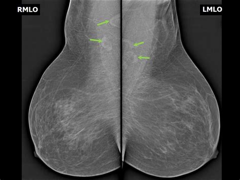 Normal Mammogram Look Like The Normal Breast And Its Variations In