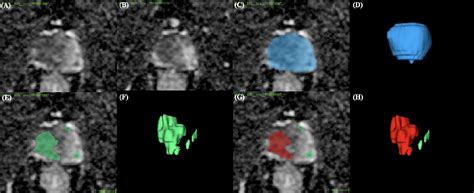 Figure 1 From Deep Learning Based Radiomics Model From Pretreatment Adc To Predict Biochemical