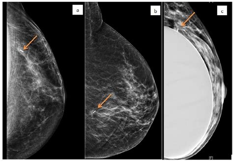 Magnetic Seed Lumpectomy At Harrison Trethowan Blog