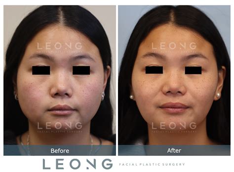 Masseter Botox