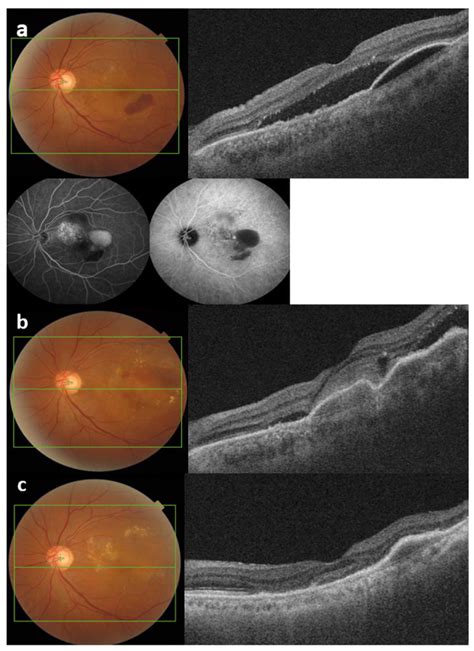 Switching From A Fixed Monthly Aflibercept Regimen To Bi Monthly Brolucizumab In Refractory