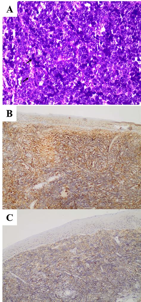 Transformation Of Low Grade Follicular Lymphoma To A High Grade