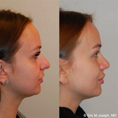 Eric M Joseph Md Rhinoplasty Before And After Results With A Droopy