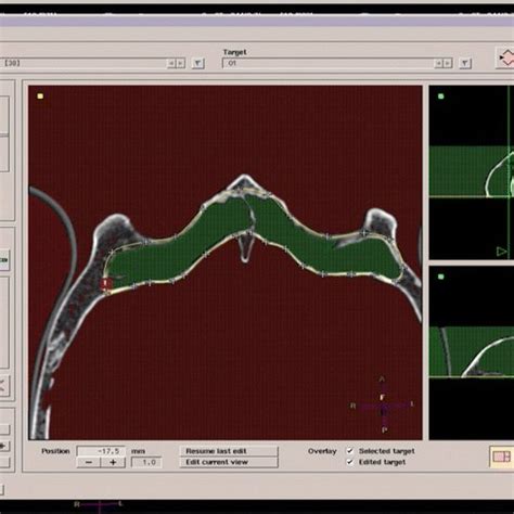 Frontal Sinus Segmentation And Volumetric Measurement Procedure On Ct Download Scientific Diagram