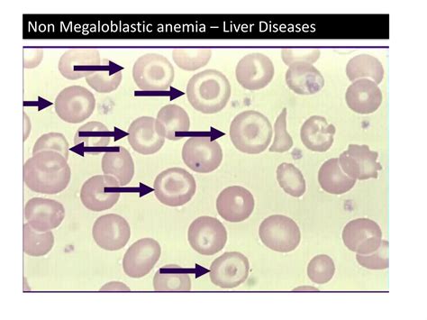 Macrocytic Anemiapdf