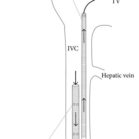Cannulation Options In Vv Ecmo A Femorojugular Configuration B Download Scientific
