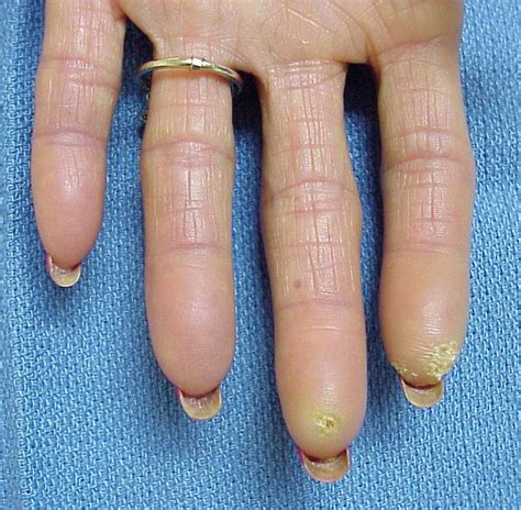 Transformation Crest Syndrome With Scleroderma Telangiectasias And Subcutaneous Calcification